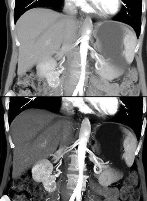 Gastrointestinal Learning Modules Ct Scanning