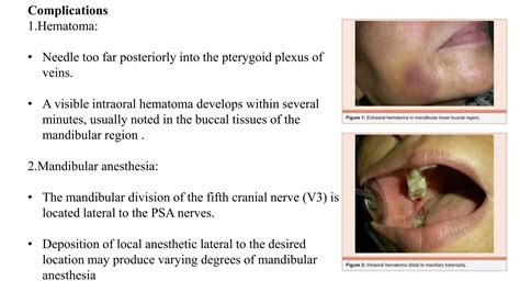 Maxillary Nerve Block Pptx