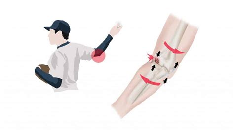 Osteochondritis Dissecans Pathology Symptoms And Diagnosis