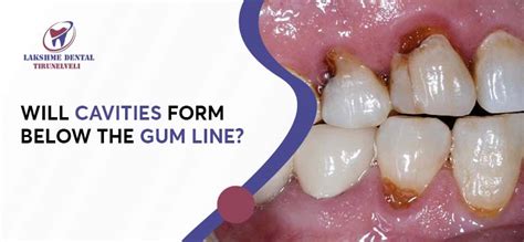 Gum Line Cavities Tooth Decay At Gum Line