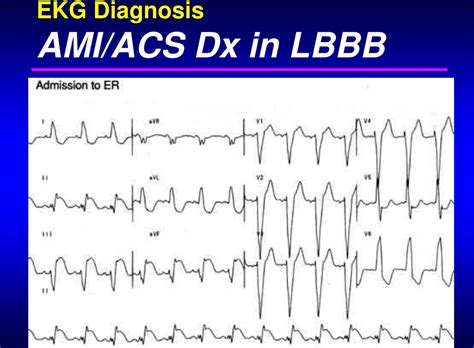 Ppt Ami Acs Diagnosis History And Physical Powerpoint Presentation Free Download Id 4501106