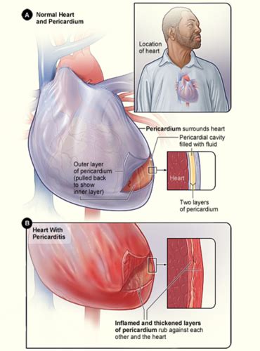 Cv Heart Murmurs Flashcards Quizlet