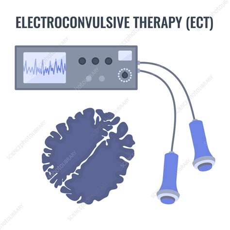 Electroconvulsive Therapy Illustration Stock Image F037 7502