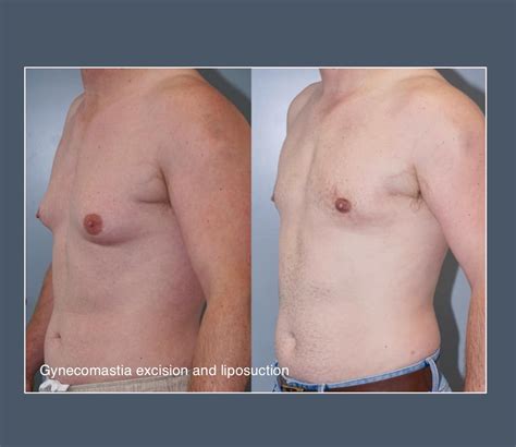 Gynaecomastia Male Breast Reduction Dr David Colbert