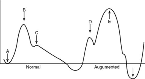 Embolectomy Basicmedical Key