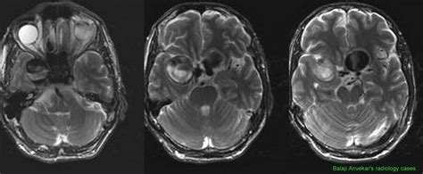 Dr Balaji Anvekar Frcr Bilateral Ica Aneurysms Mr Angio