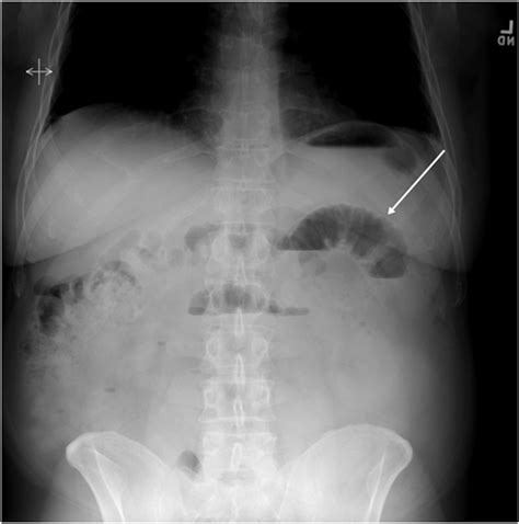 Unusual Presentation Of Intussusception Gallstone Ileus Radiography