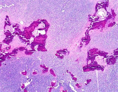 Ewing Sarcoma Of Bone Light Micrograph Stock Image C061 1656 Science Photo Library