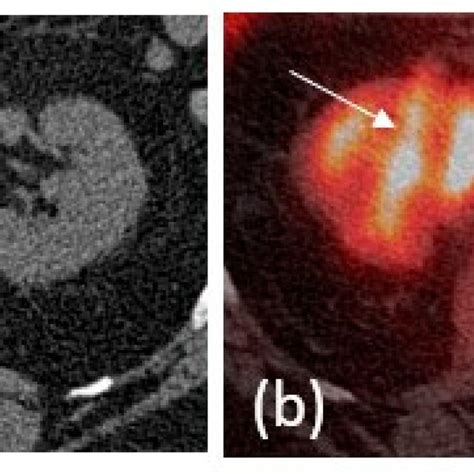 A 63 Year Old Male With Metastatic Utuc A Non Contrast Ct Images