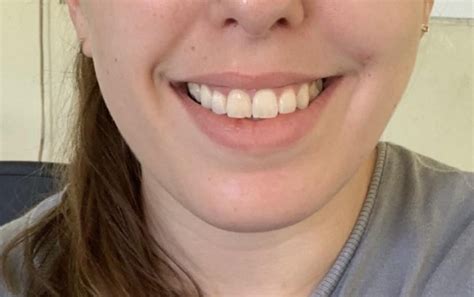 Tips For Starting Refinement Trays See Comment For Details R Invisalign