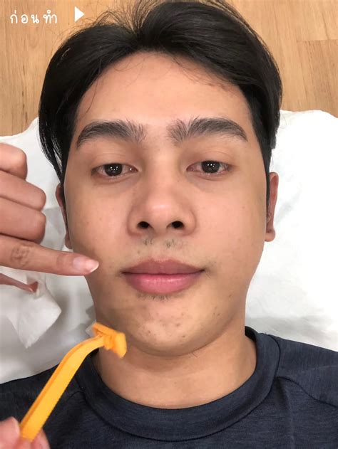 รีวิว เลเซอร์หนวดเครา ผู้ชาย🤴🏻ep 8 แกลเลอรีที่โพสต์โดย Mchakorn Lemon8