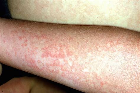 Fifth Disease Symptoms Causes Treatment And More