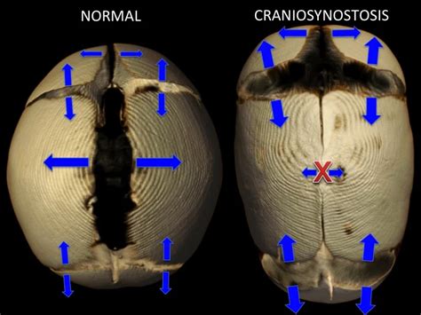 Isolated Craniosynostosis — Dallas Pediatric Plastic Surgeon Craniofacial Surgeon Cleft Lip