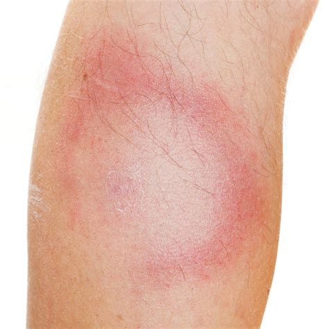 Normal Tick Bite Reaction