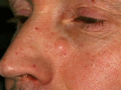 How To Spot And Treat Epidermoid Cysts