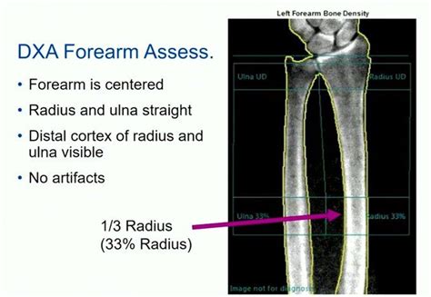 China Dual Energy X Ray Absorptiometry Bone Densitometry Peripheral