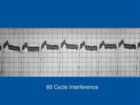Ecg Strips Of Cardiac Rhythms Eyas Almousa Md Facc Ppt Download