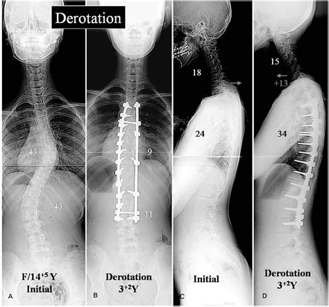 Lumbar Spine Curve