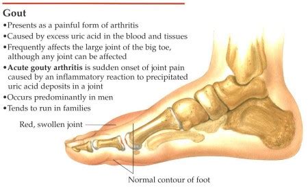 Gout Disease What You Must Know Health Blog Centre Info