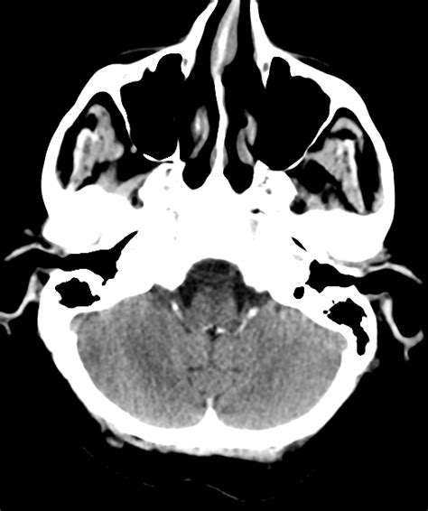 Radiopaedia Case Choroid Plexus Calcification Through The Foramina Of Luschka Id 35219 Study