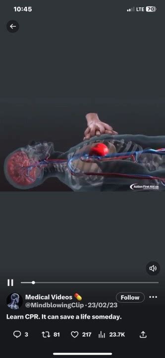 Sandeep Ingilela On Linkedin Cpr Cardiac