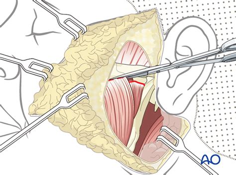 Masseter Muscle Transposition For Irreversible Paralysis Midface And Mouth