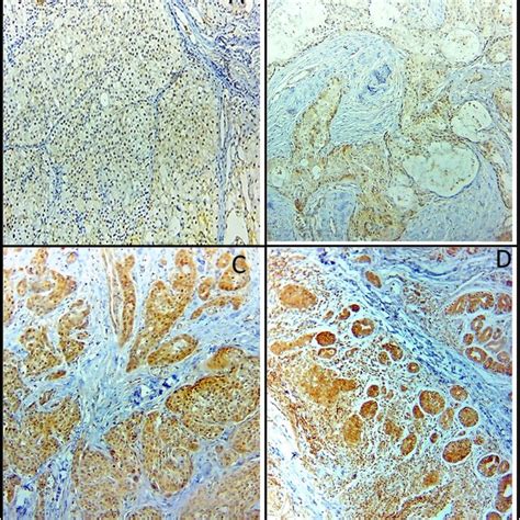 Strong Ctsk Ihc Expression In Cxpa A B Positive Ctsk Expression In Download Scientific