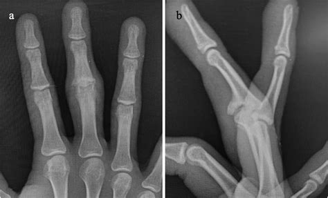 Proximal Interphalangeal Joint Dislocations And Fracture Dislocations