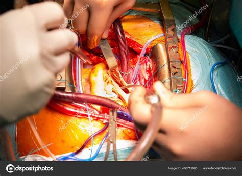 Open Heart Surgery Diagram