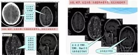 腔隙性脑梗死诊疗中的9大雷区你踩过吗 澎湃号湃客 澎湃新闻 The Paper