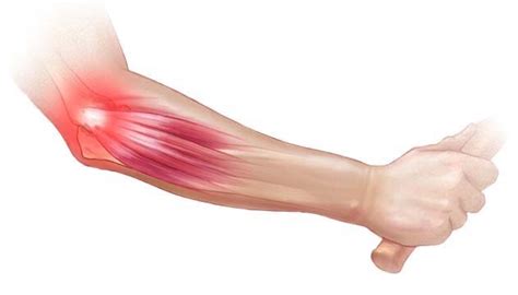 Tennis Elbow Dc Injury Clinic