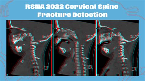 Rsna 2022 Cervical Spine Fracture Detection