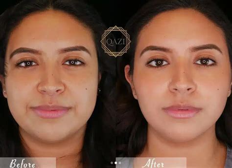 Pdo Threads Before And After See Photo Gallery Medical Spa Rx