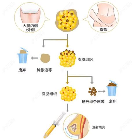 脂肪填充胸部多久后可以填充第二次 第2次填充还收费吗 整容资讯 彩贝整容网