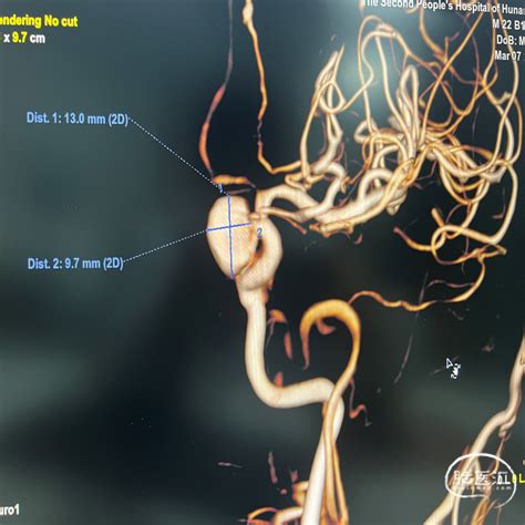 Time To Evolve 超越之旅 Surpass Evolve治疗外伤性假性动脉瘤一例及6个月随访 脑医汇
