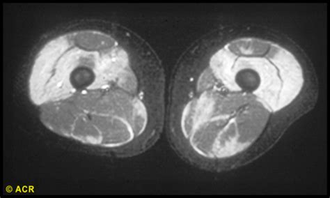 Myositis Flashcards Quizlet