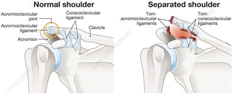 Acromioclavicular Joint Separation Illustration Stock Image F035 7795 Science Photo Library