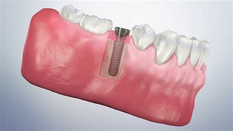 Golden Peak Dental Educational Videos Prophy Vs Scaling And Root