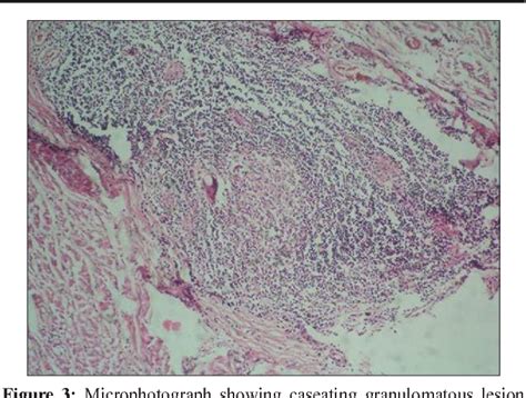 Figure 1 From Tuberculosis Of Nose And Palate With Vanishing Uvula
