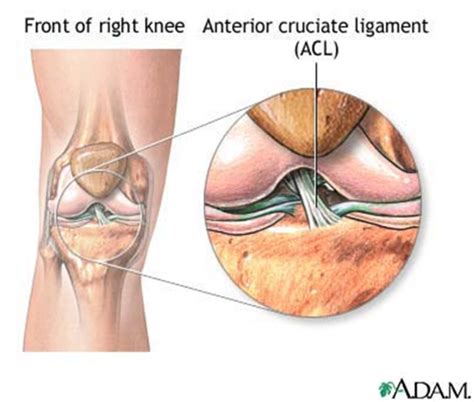 Acl Tear Brisbane Knee And Shoulder Clinic Dr Kelly Macgroartybrisbane Knee And Shoulder Clinic