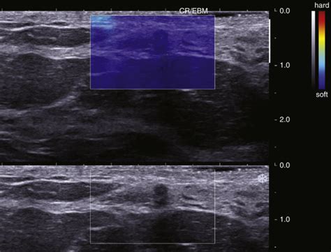 Breast Ultrasound Principles Clinical Tree