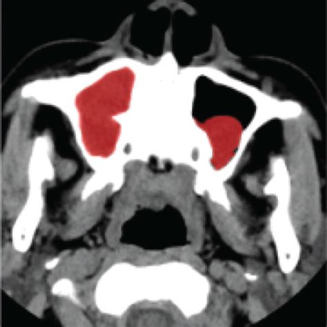 Segmentation Results Of Augmented Gradient Based Level Set Method In Ct Download Scientific