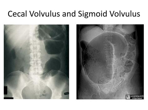 Cecal Volvulus Vs Sigmoid Volvulus My Xxx Hot Girl