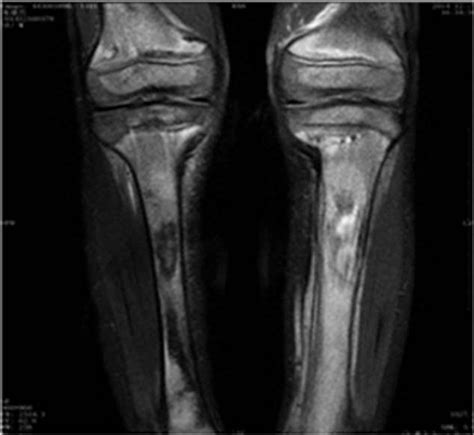 Acute Lymphoblastic Leukemia Arising After Treatment Of Ewing Sarcoma Was Misdiagnosed As Bone