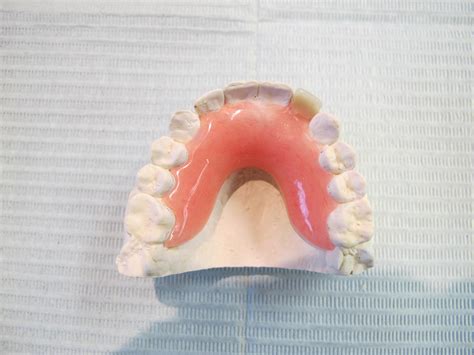 Partial Dentures In Windsor Baker Lanoue Denture Clinic