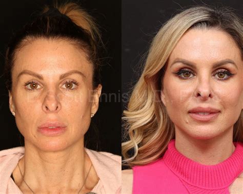 The Mar A Lago Face Is A Refined And Timeless Look By Dr Ennis