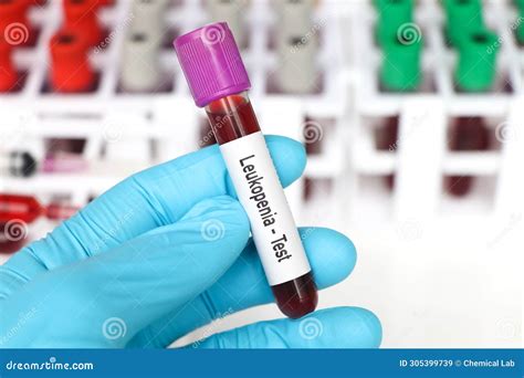 Leukopenia Test Blood Sample To Analyze In The Laboratory Stock Image Image Of Biology Leukopenia Test Blood Sample To Analyze In The Laboratory Stock Image Image Of Biology