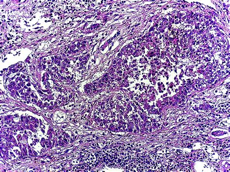 Hepatocellular Carcinoma With An Acinar Growth Pattern Tumoral Cells Download Scientific