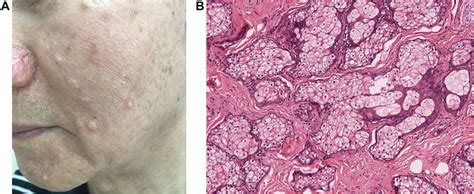 Diseases Of The Sebaceous Gland