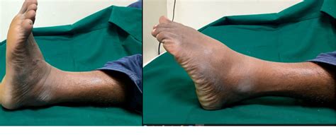 Ankle Fractures Expert Diagnosis And Treatment Ganga Hospital
